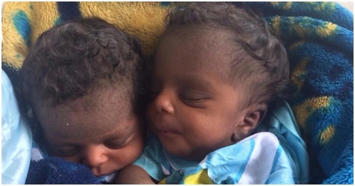 Joy and relief as conjoined twins are successfully separated in life ...