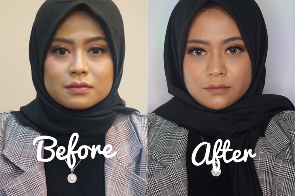 CARA MEMBUAT WAJAH JADI TIRUS DENGAN FILLER DAGU & BOTOX V SHAPE DI ...