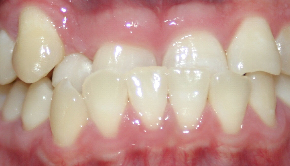 James R. Waters, DDS, MSD, PA: Re-shaping and polishing edges of teeth ...