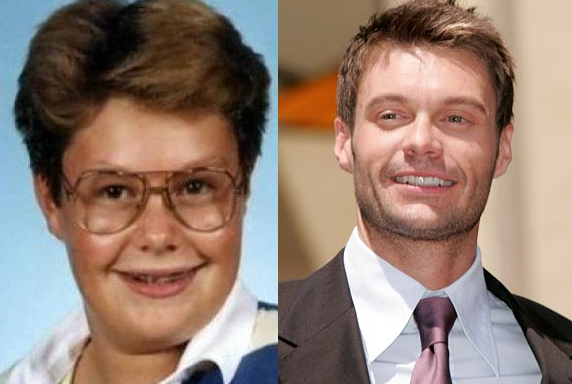 Ryan Seacrest Plastic Surgery