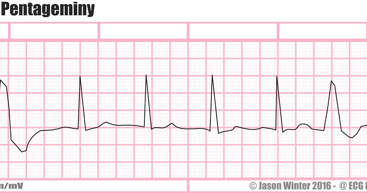 ECG Educator Blog : Ventricular Pentageminy