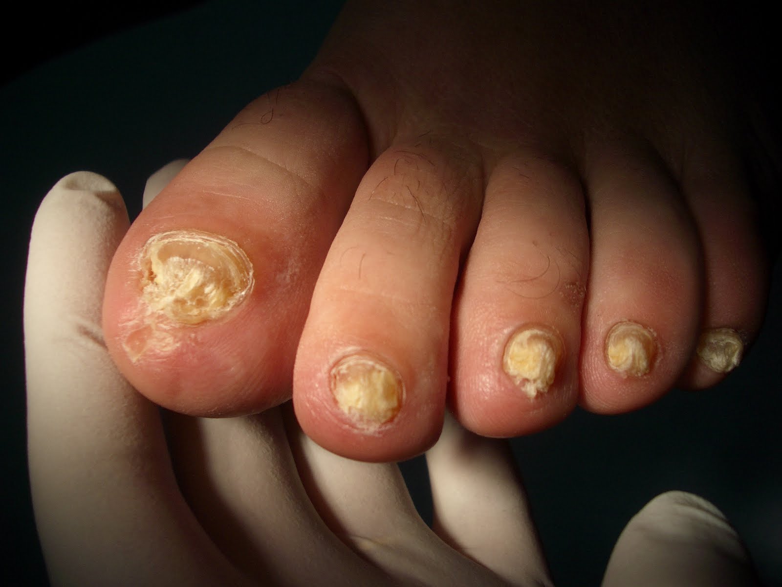 Fotos Micose De Unha - BRAINCP