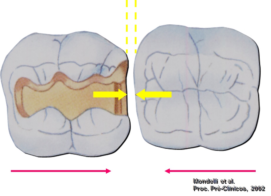 Saúde da Boca: Preparo Cavitários- CAVIDADES CLASSE I e II PARA AMÁLGAMA
