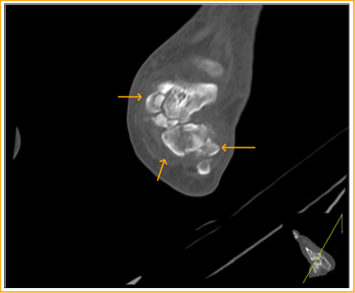 Neuropathic Joint (Charcot Joint) - Sumer's Radiology Blog
