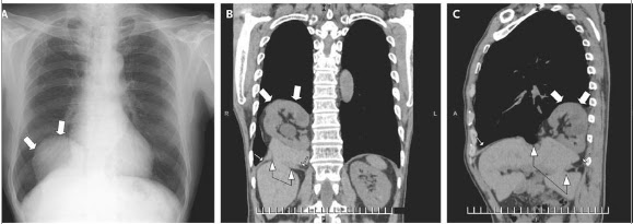 Doctors Gates: Thoracic Kidney