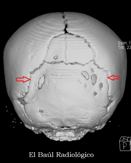 El Baúl Radiológico: CRANEOSINOSTOSIS. CIERRE PREMATURO DE LAS SUTURAS ...