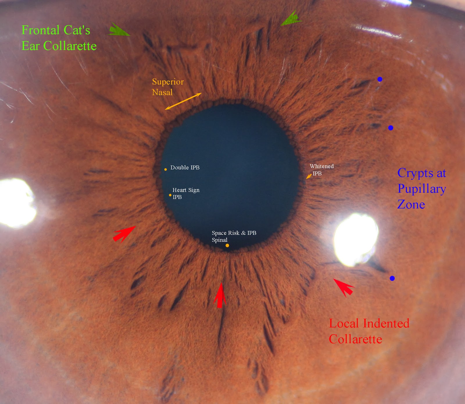 Modern & Multidimensional Iridology: IPB Morphologies, Space risk, IPB ...