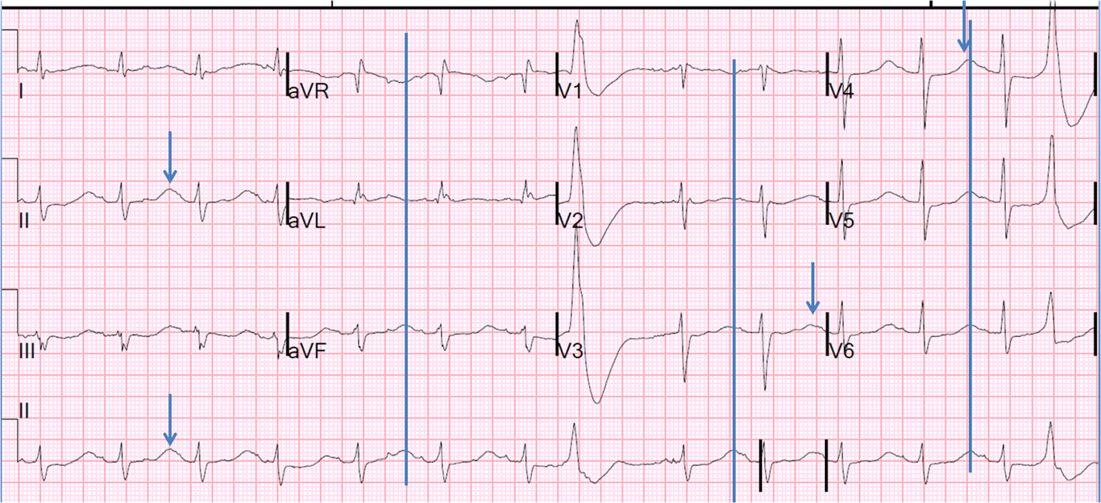 Dr. Smith's ECG Blog: Young woman with weakness. The ECG is ...