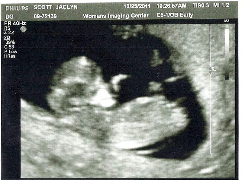 Our Scott Spot: 11 Week Ultrasound