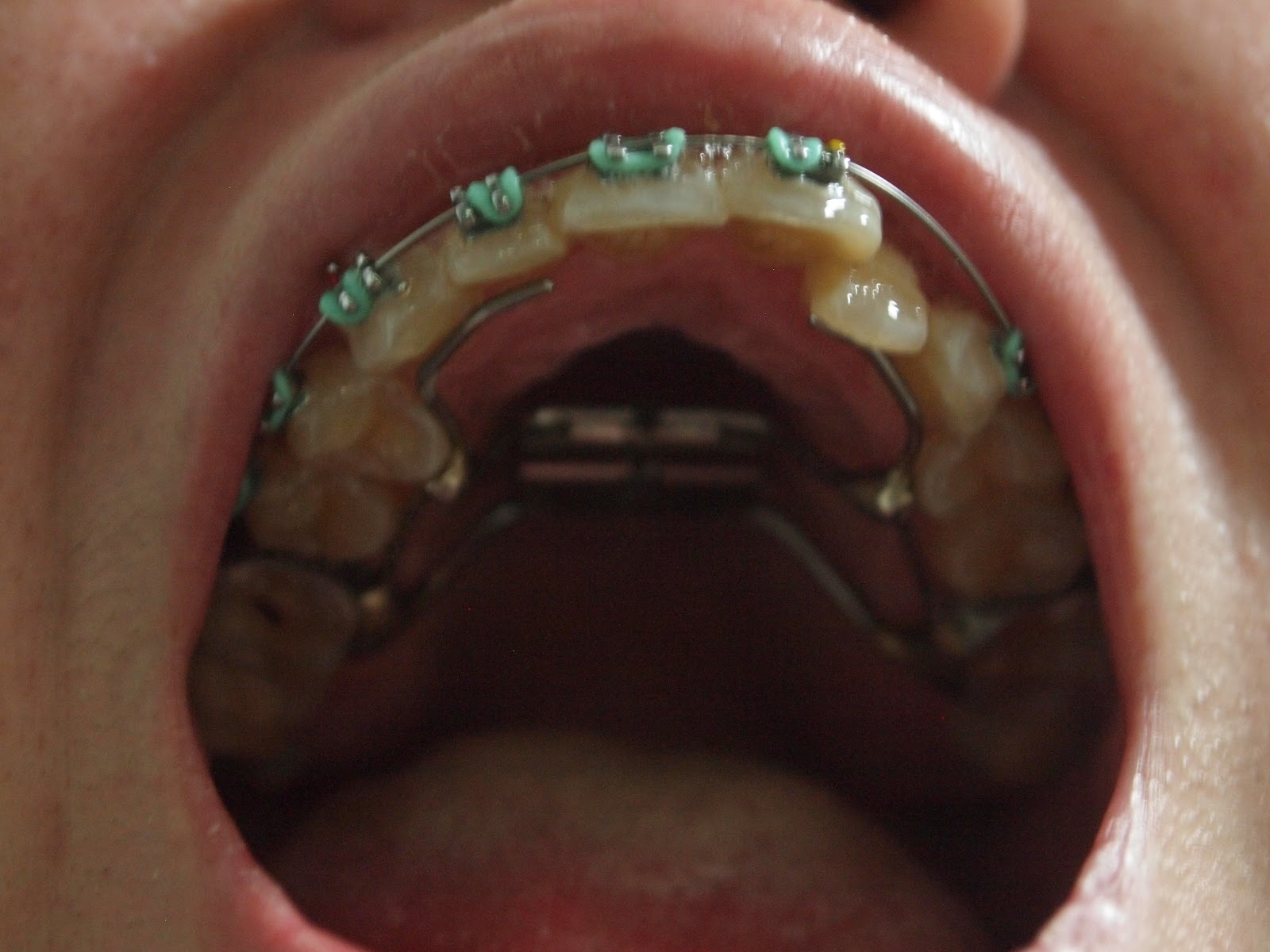 My WonderWall: Braces up!