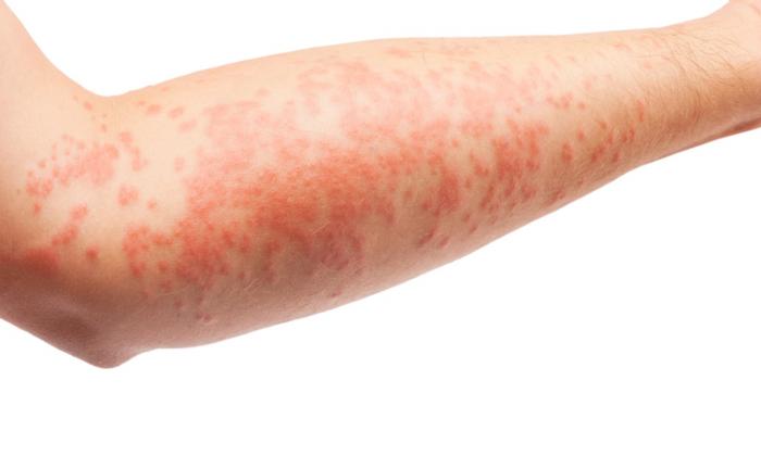 Common skin rashes: Pictures, causes, and treatments ~ healthtipz