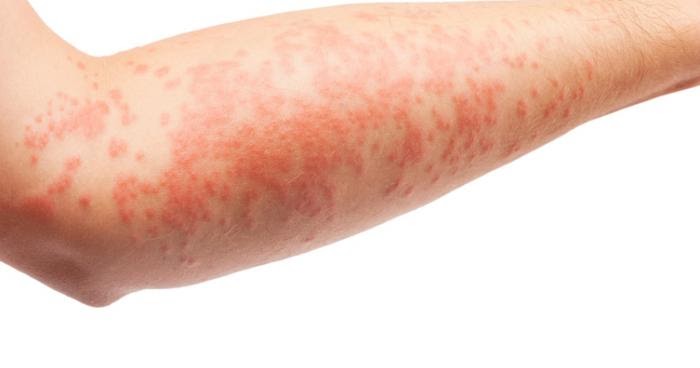 Common skin rashes: Pictures, causes, and treatments ~ healthtipz