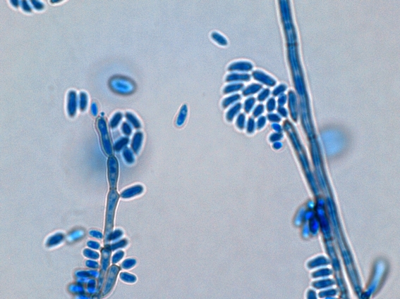 Fun With Microbiology (What's Buggin' You?): Exophiala dermatitidis