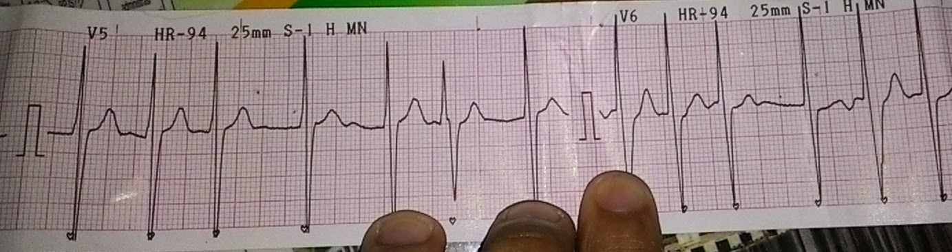 Right Ventricular Hypertrophy (RVH) pada EKG? | SholehShare