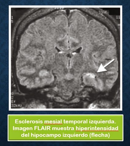ESPE 203-2013: Secuencias Cerebro y Epilepsia