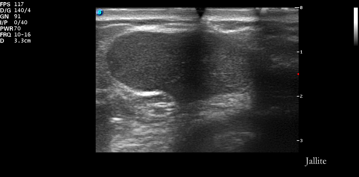 Nódulo Mamario post Mastectomía