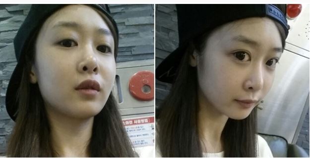 GNG Plastic Surgery Hospital: Real Story-Doctor Fixed My Awkward Nose ...