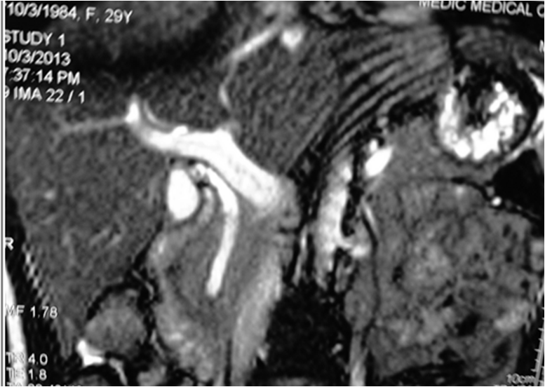 VIETNAMESE MEDIC ULTRASOUND: CASE 213: BILOBED GALLBLADDER, Dr PHAN ...