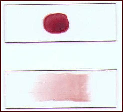 Medical Laboratory Technology - SOP: Thin & Thick blood smear preparation
