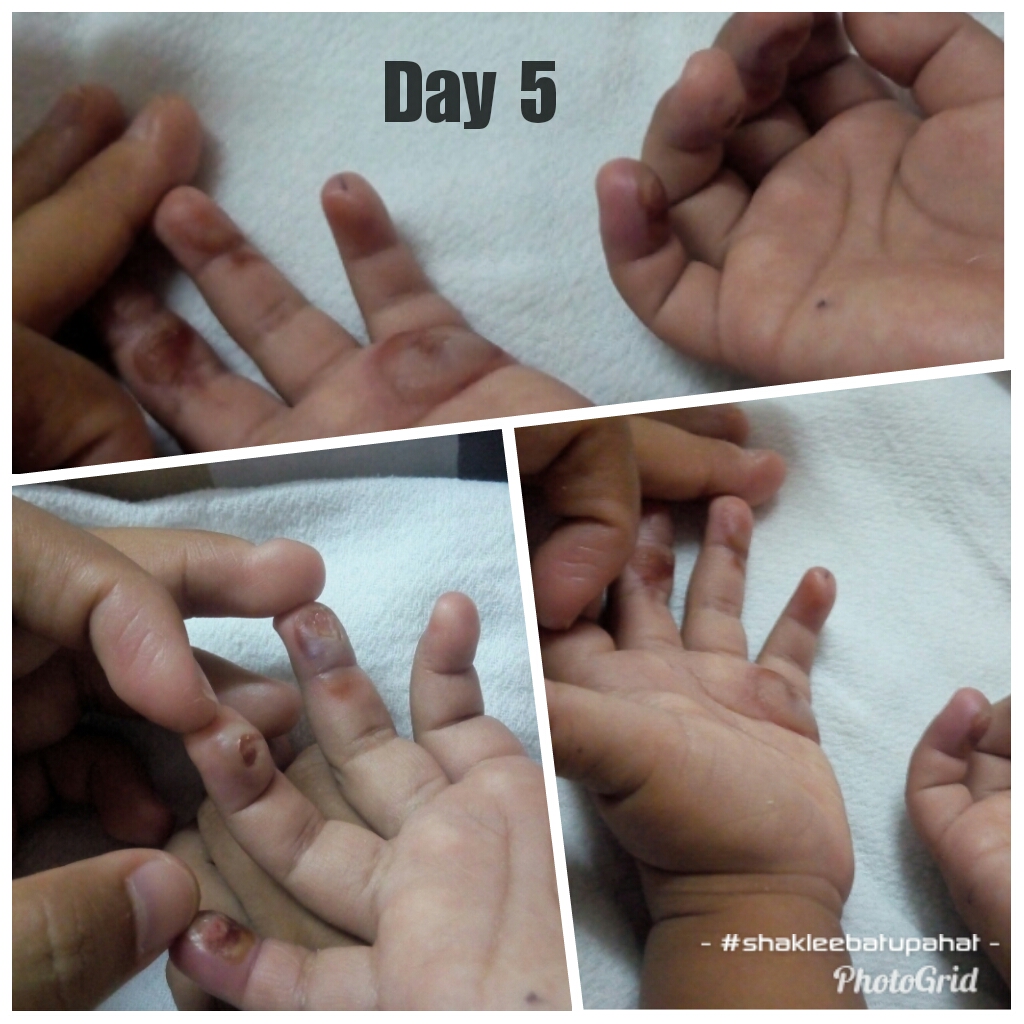 Pengalaman Luka Berdarah | akuayut