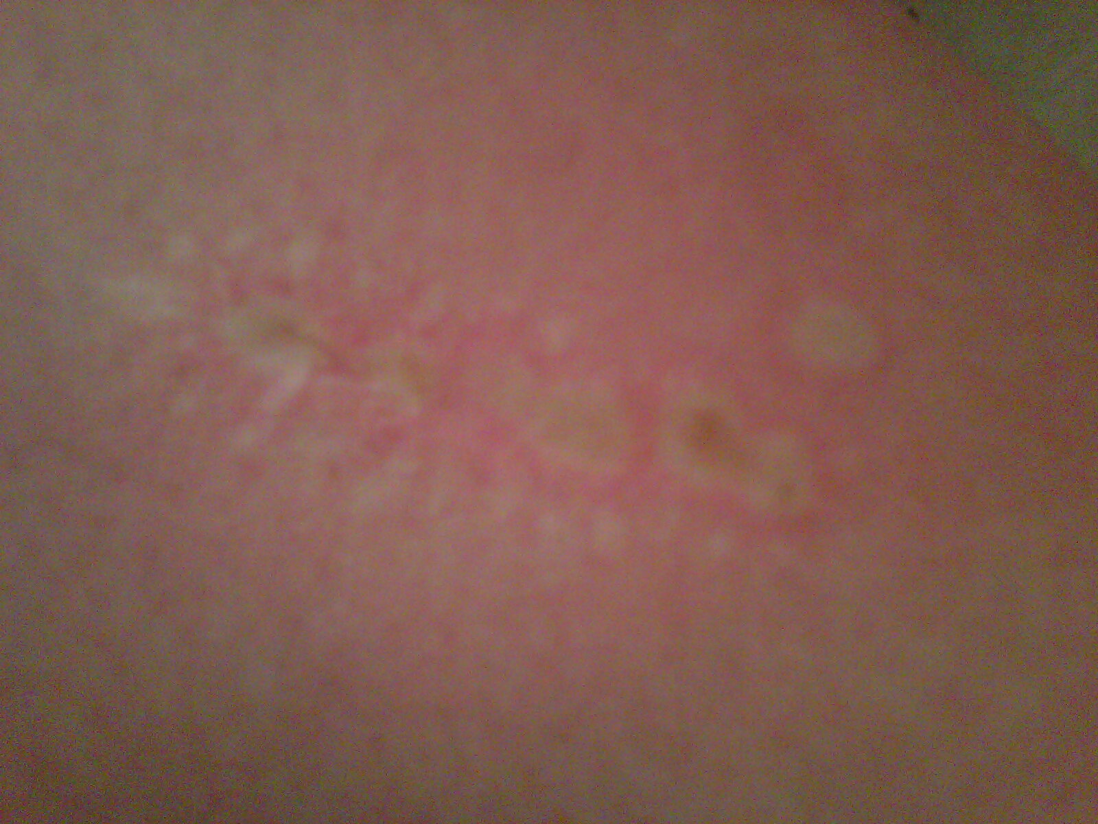 Self Injury Journey: Cigarette Burns on Flesh - Day 1