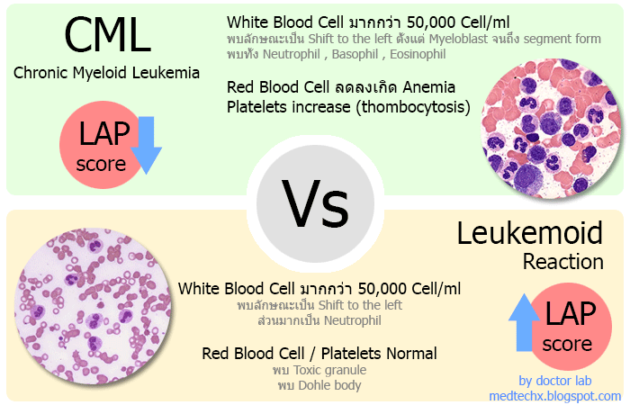 Doctor Lab (medtech): ความแตกต่างระหว่าง Leukemoid Reaction และ Chronic ...