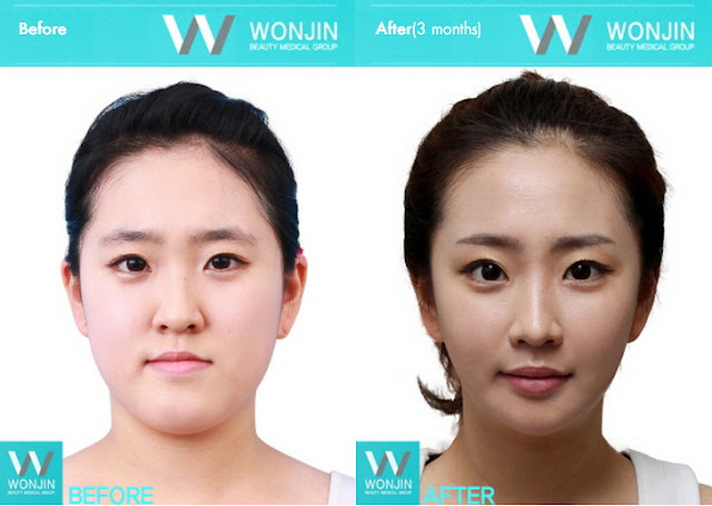 [Before and After Photos] Korean Face Contouring - 짱이뻐!