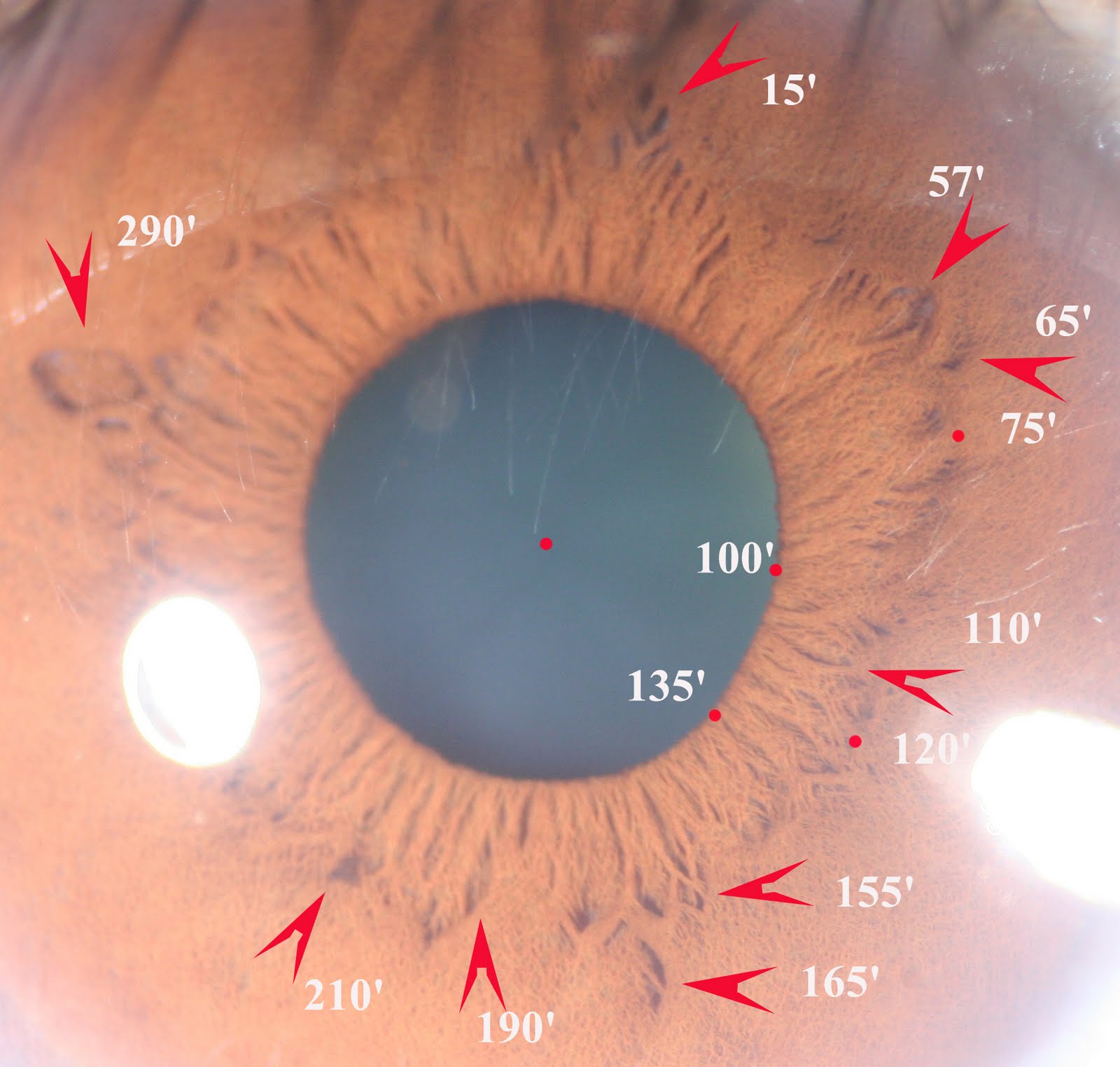 Modern & Multidimensional Iridology: Pupil & Collarette Analysis ...