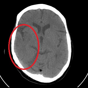 POINT OF VIEW: DX: Acute-hyperacute stroke of the right MCA, M2 territory