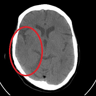 POINT OF VIEW: DX: Acute-hyperacute stroke of the right MCA, M2 territory