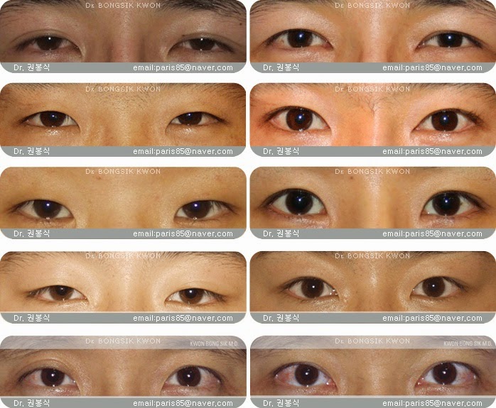 Teuim Aesthetic Plastic Surgical Clinic Dr.Kwon: What is non-incisional ...