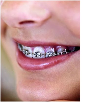 Dental treatment, braces, tooth ache, dentist.....: Braces, Orthodontic ...