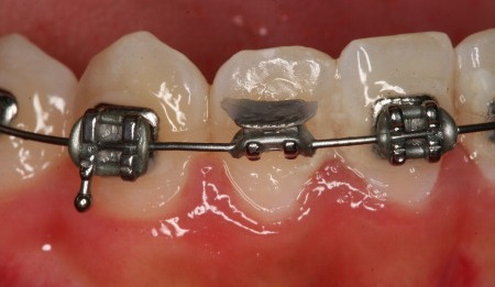 Ortodoncia Internacional: Doctor se me cayó un bracket y no me va a ...