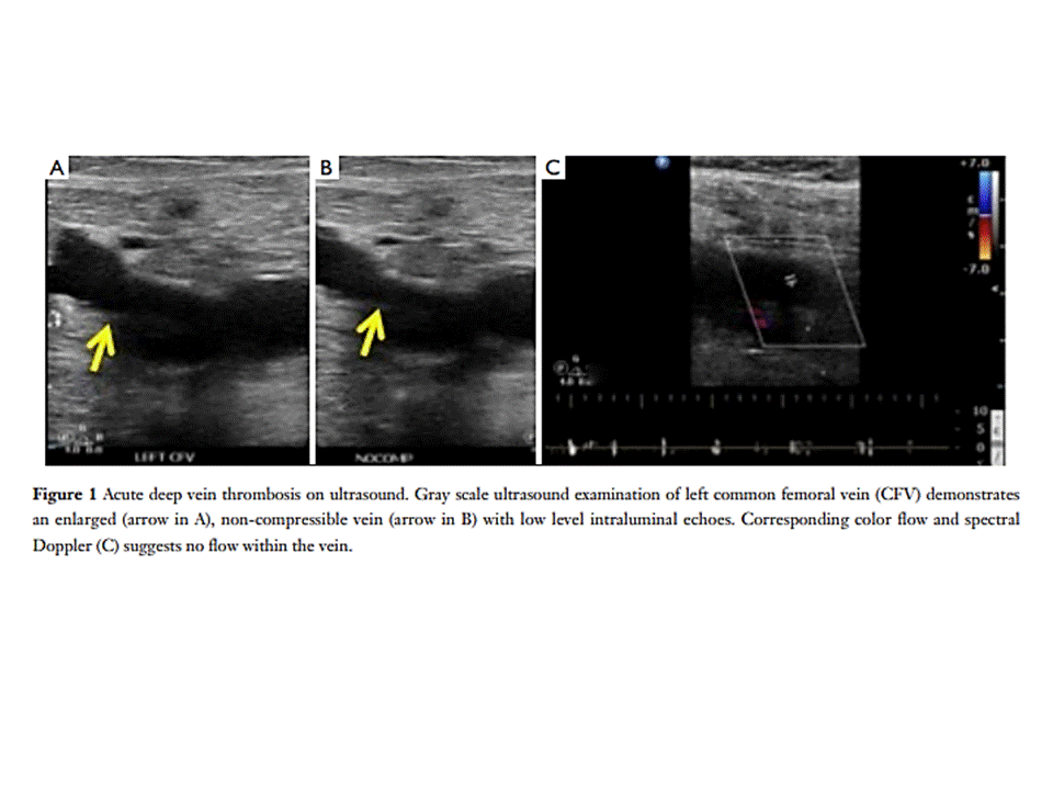 BÀI SOẠN VỀ SIÊU ÂM CHẨN ĐOÁN: Acute and Chronic DVT and Ultrasound (US)
