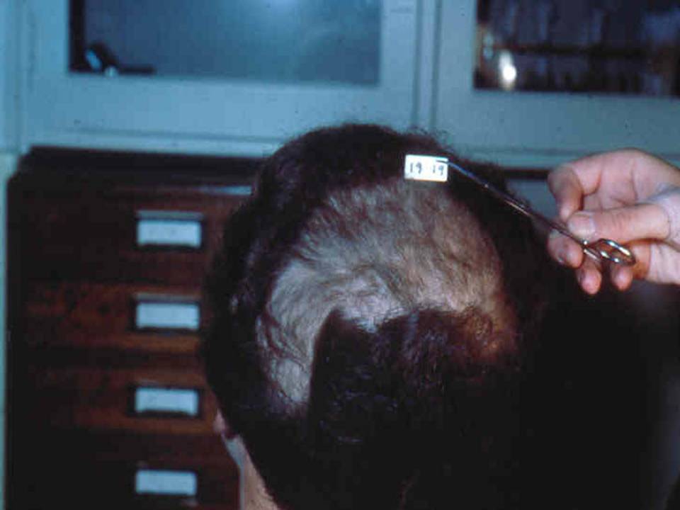 Consultations in Dermatology: Factitial scars - Dermatitis Artefacta