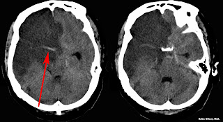 Roentgen Ray Reader: Hyperdense MCA Sign