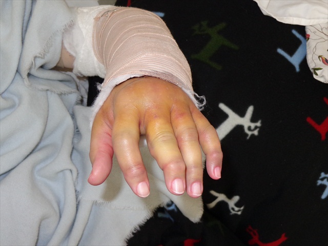 Here's Your Gold Watch - Rheutired: Wrist Fusion Surgery