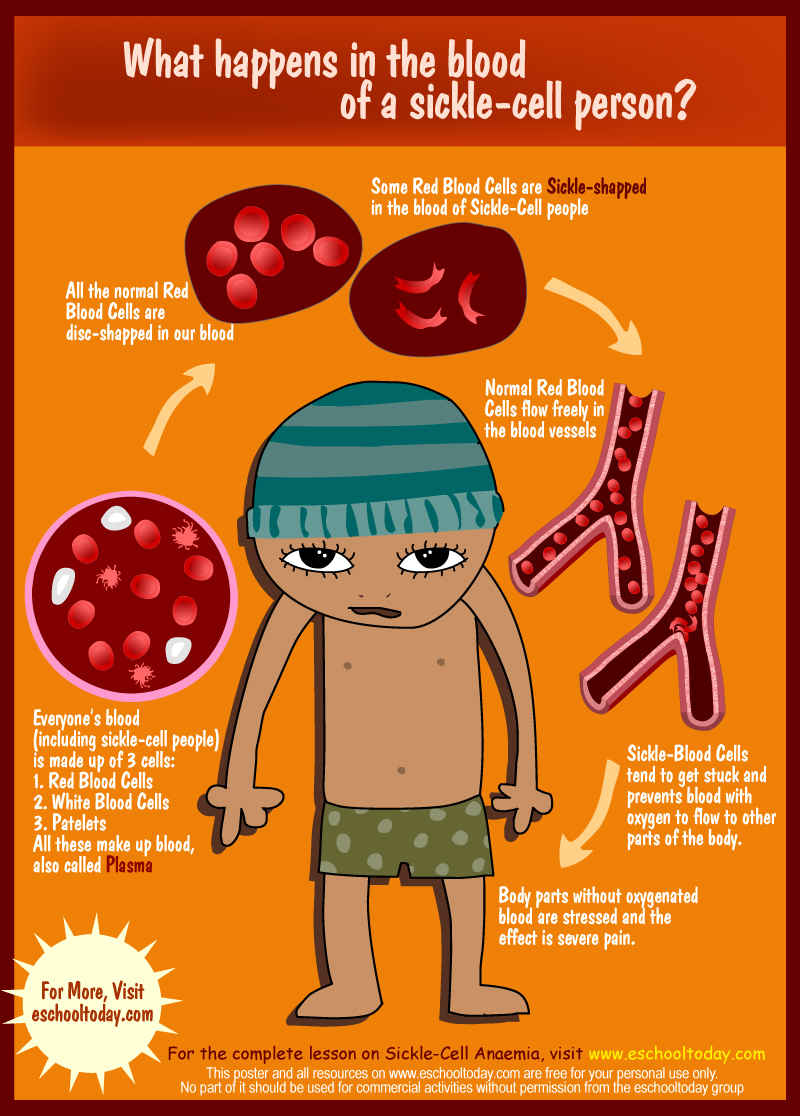 Anemia Sel Sabit (Sickle-Cell-Anemia)