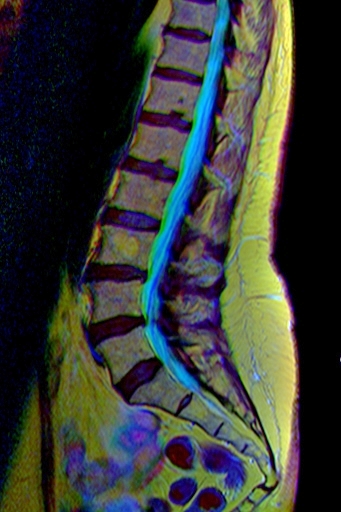Nevit's blog: Color MRI of spine