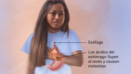 5 ENFERMEDADES DEL SISTEMA DIGESTIVO: ENFERMEDAD REFLUJO GASTROESOFÁGICO