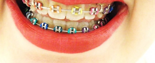 Blog de OdontoPack: BRACKETS DE COLOR: ¿MODA O TENDENCIA?