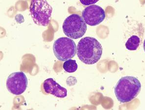 FICHERO DE HEMATOLOGÍA: ANORMALIDADES LEUCOCITARIAS. Cambios en el ...