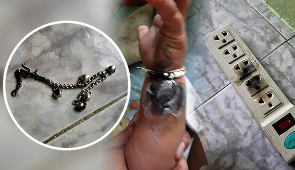 Awasi Anak Anda Main Listrik! Lengan bayi Ini melepuh akibat Kesetrum ...