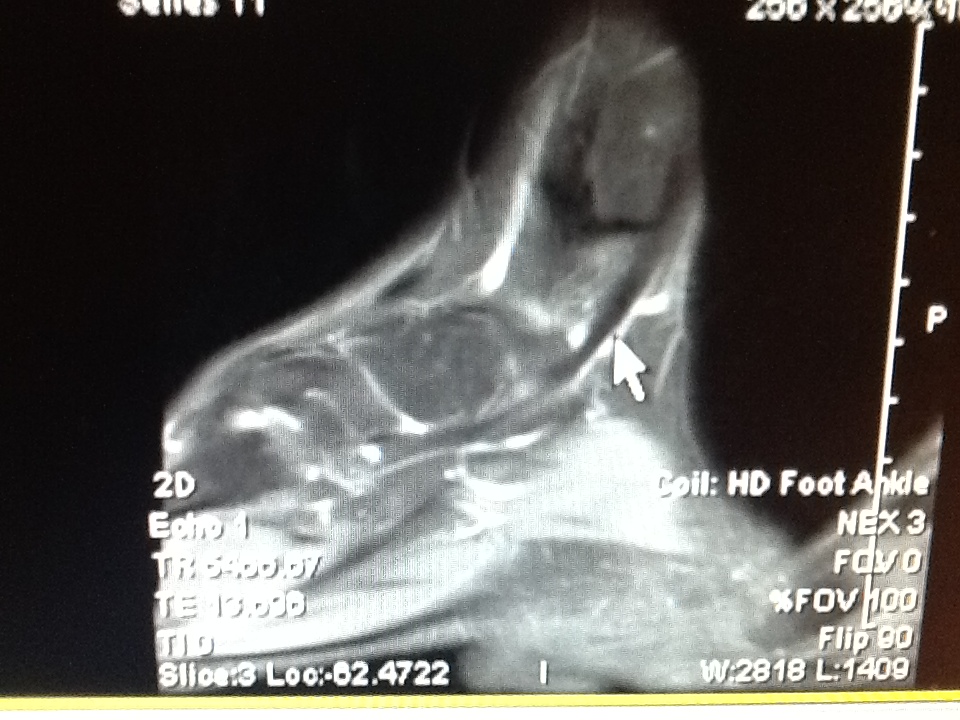 Foot and Ankle Problems By Dr. Richard Blake: Images for Os Navicularis ...