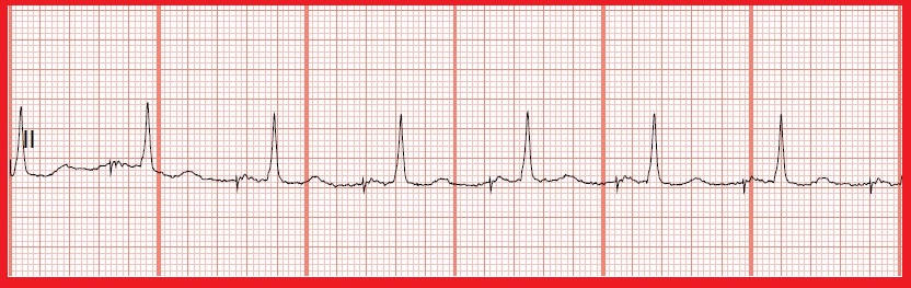 Practice EKG Rhythm Strips 203