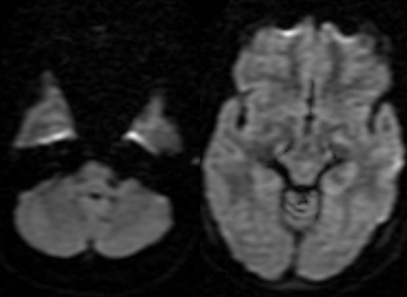 Dr Balaji Anvekar FRCR: Role of MRI Diffusion