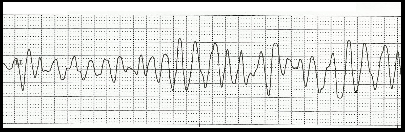 Float Nurse: ECG Rhythm Strip Quiz 97: Ventricular Rhythms