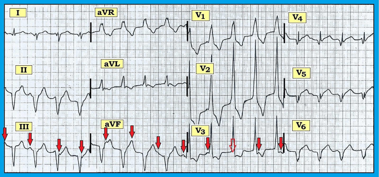 ECG Interpretation: ECG Blog #134 — Is there AV Dissociation?