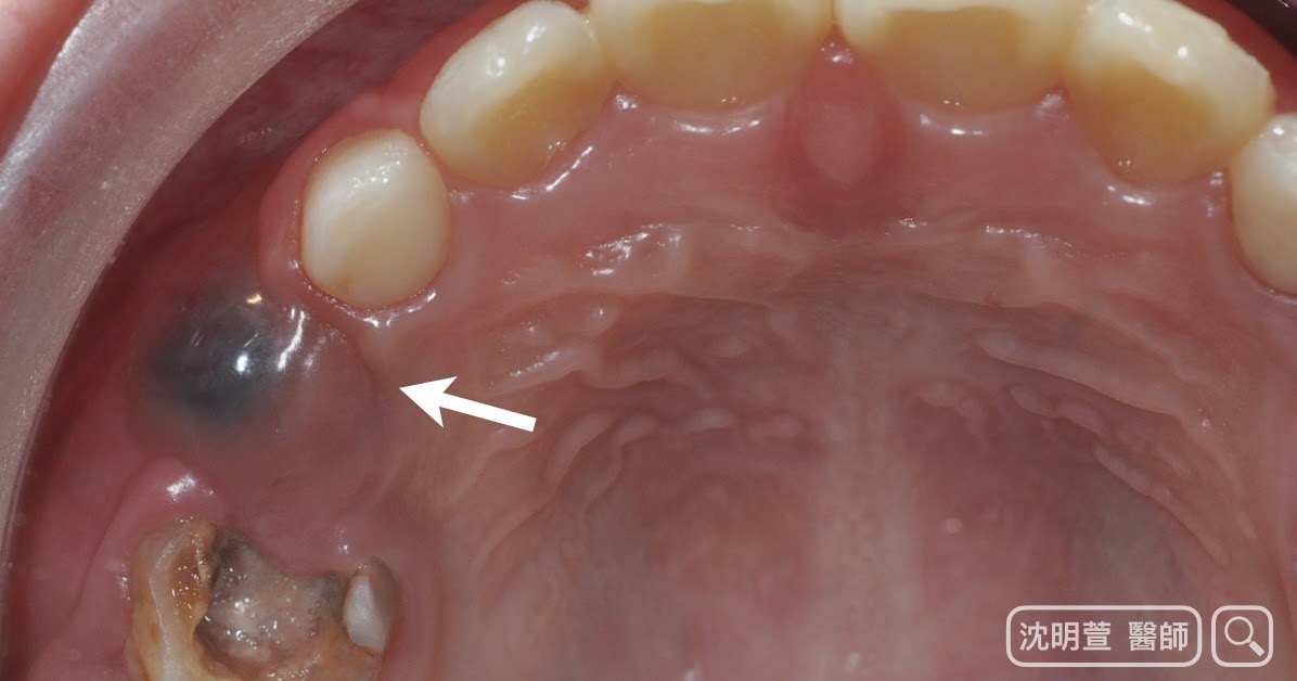 兒童牙醫沈明萱: 長牙時的特殊狀況：¹血泡 ²小碎片