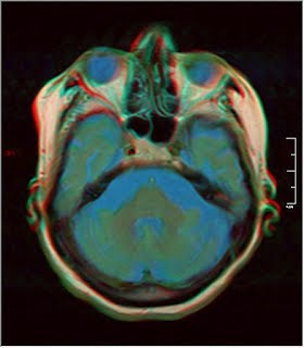 Nevit's blog: False-color Brain MRI (Motion artifacts)